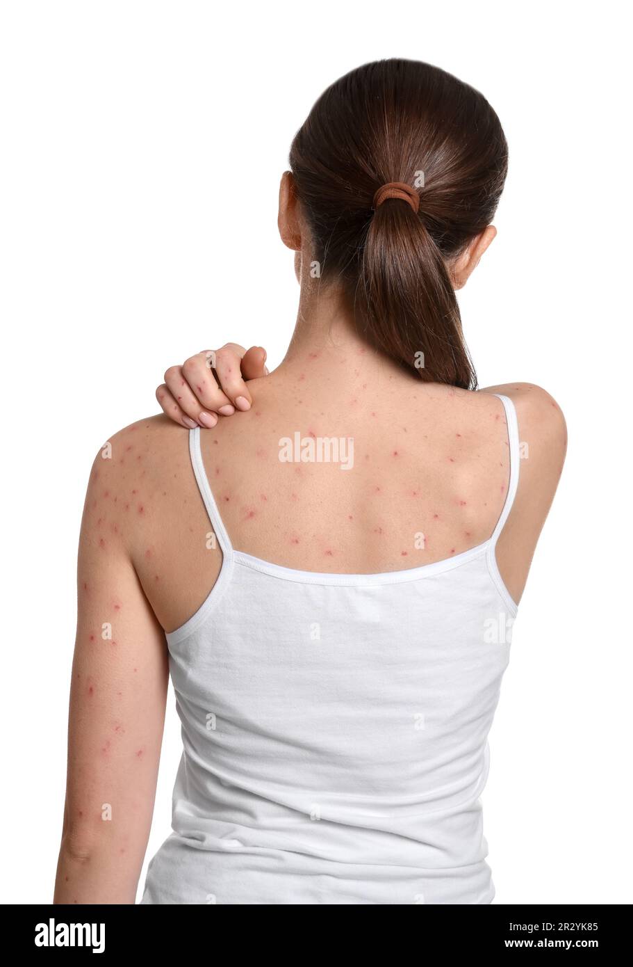 Woman with rash suffering from monkeypox virus on white background ...