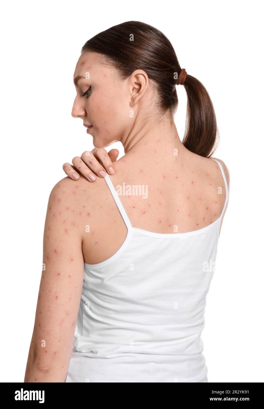 Woman with rash suffering from monkeypox virus on white background ...