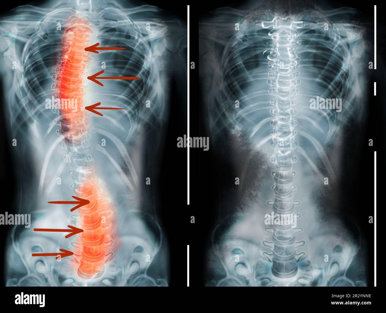X-rays of human normal and curved spines. Patient suffering from ...