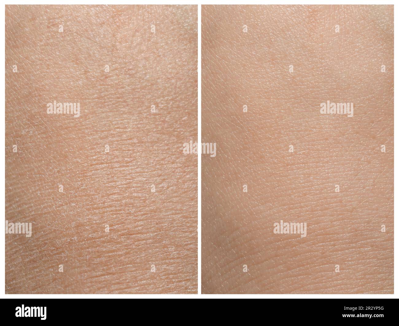 Collage demonstrating comparison of dry and moisturized human skin ...
