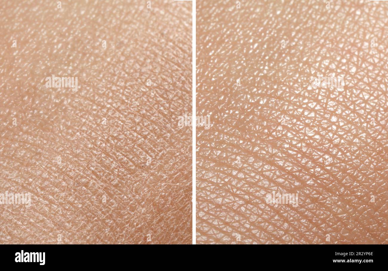 Collage demonstrating comparison of dry and moisturized human skin ...