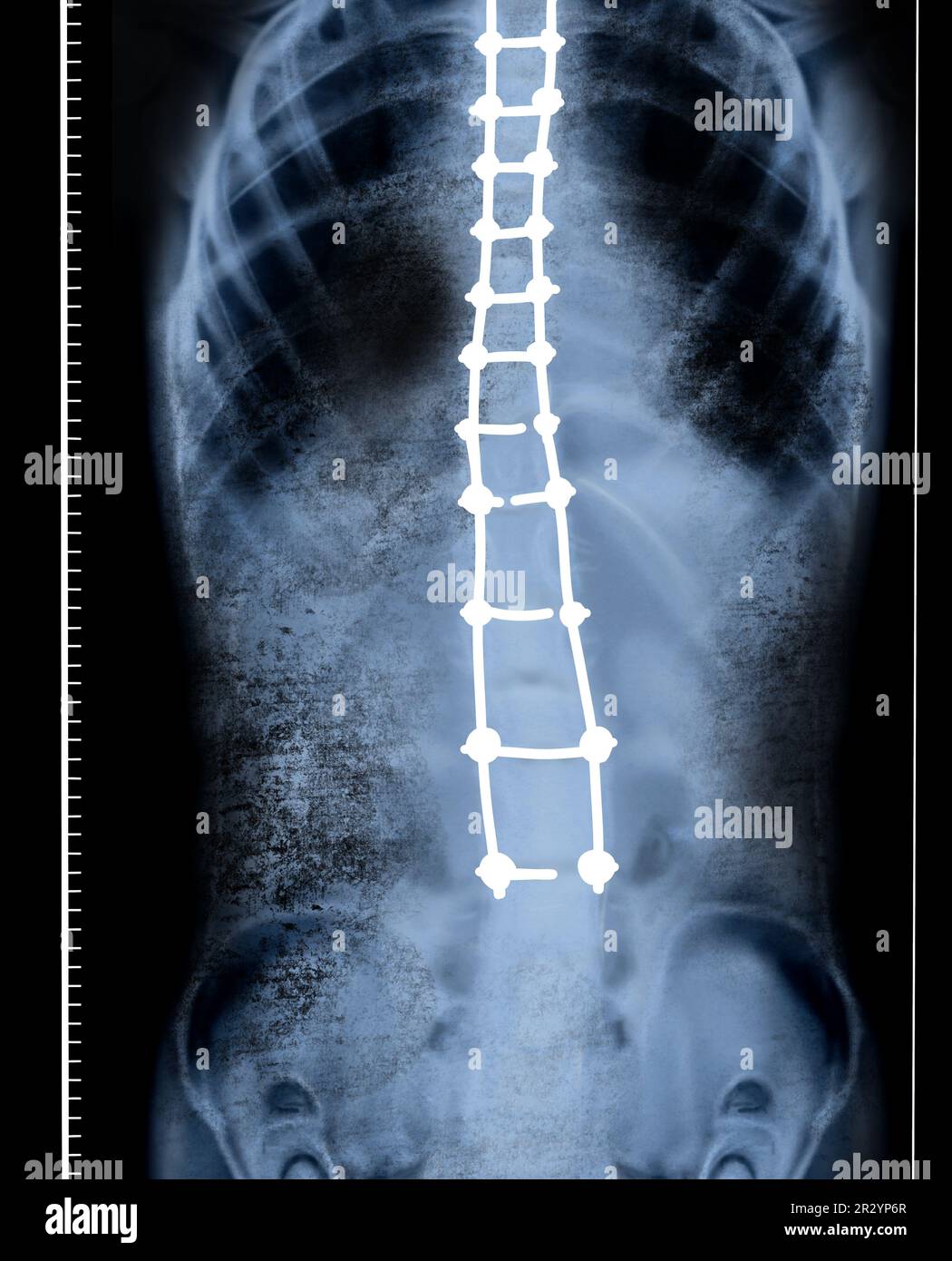 X-ray of human spine showing curvature. Patient suffering from ...