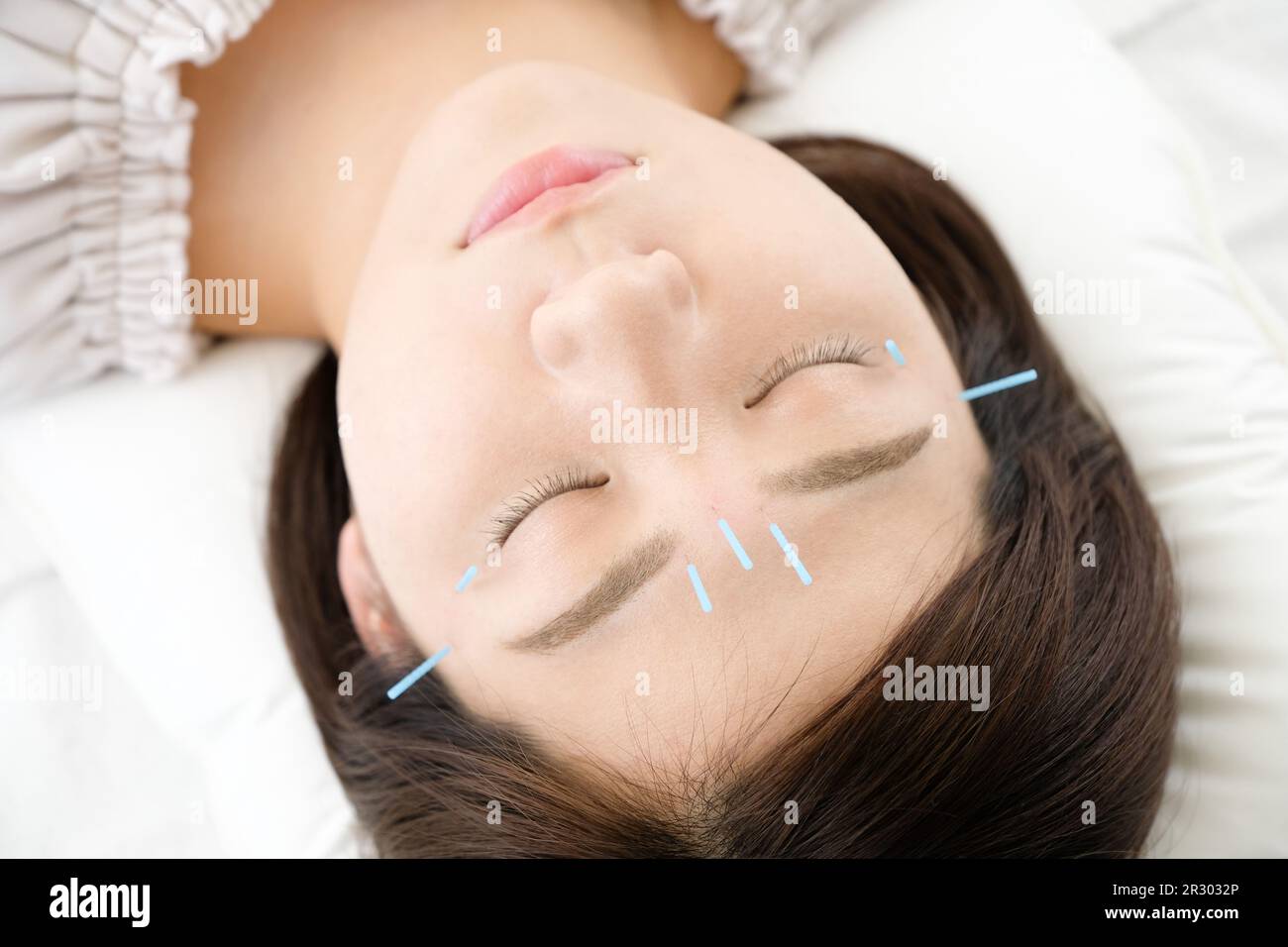 Up of a woman getting acupuncture on her face at an acupuncture clinic ...