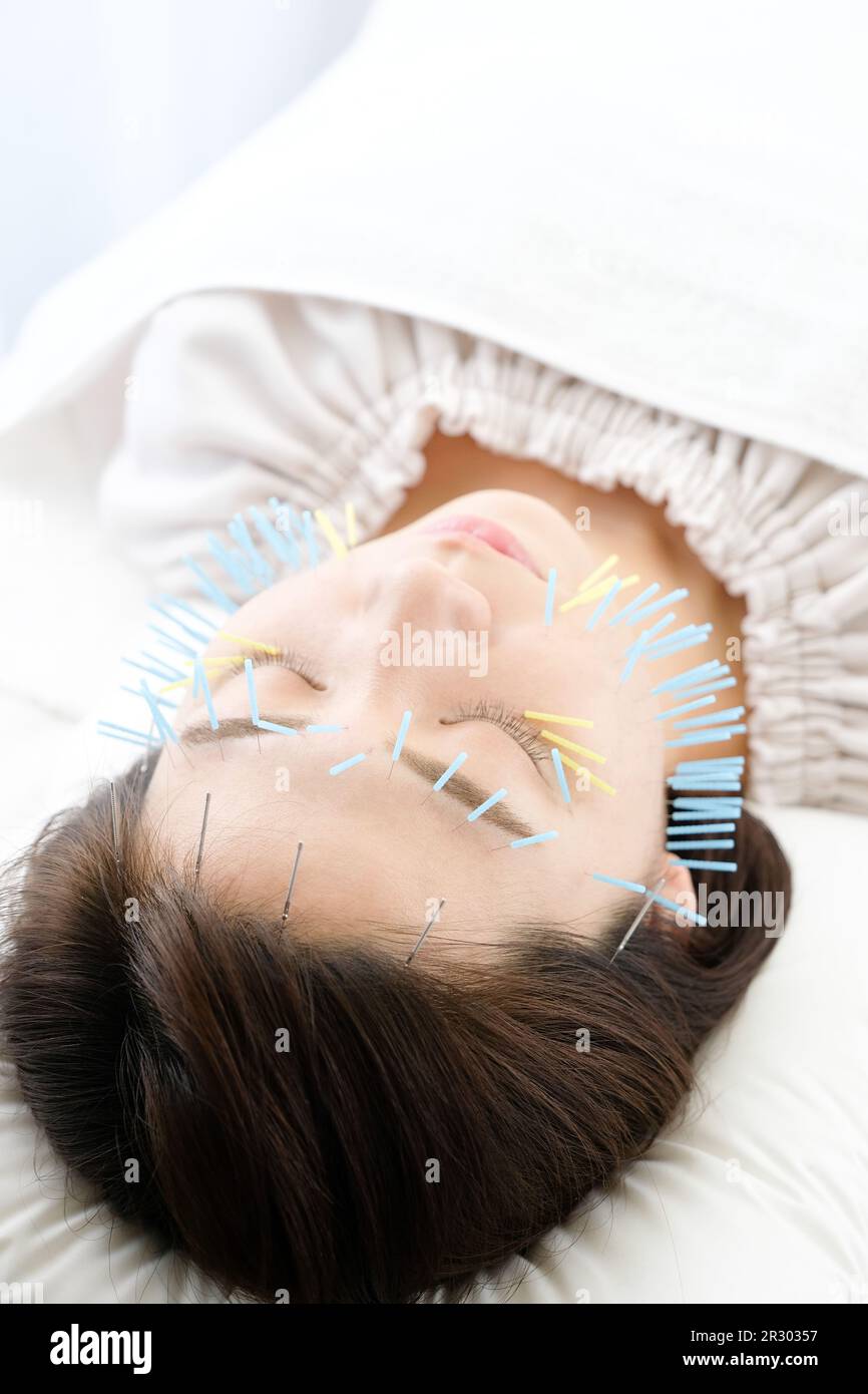 Up of a woman getting acupuncture on her face at an acupuncture clinic ...