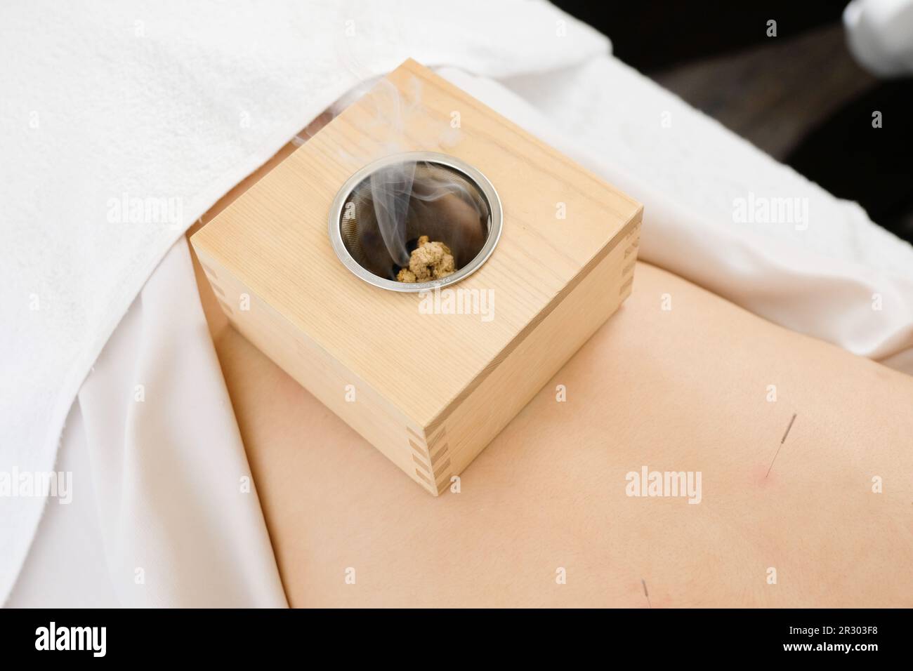 Box moxibustion placed on a woman's waist in a bright acupuncture ...