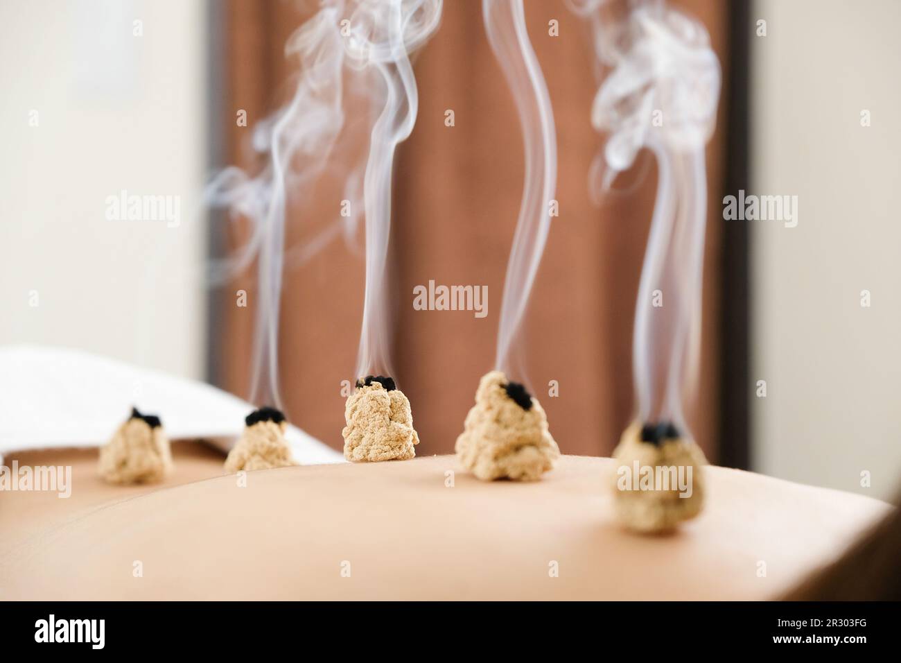 Acupuncture and moxibustion on the back of a woman in a bright ...