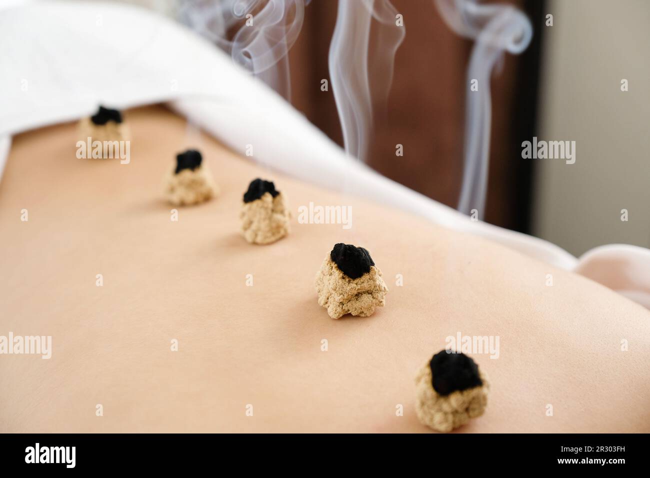 Acupuncture and moxibustion on the back of a woman in a bright ...