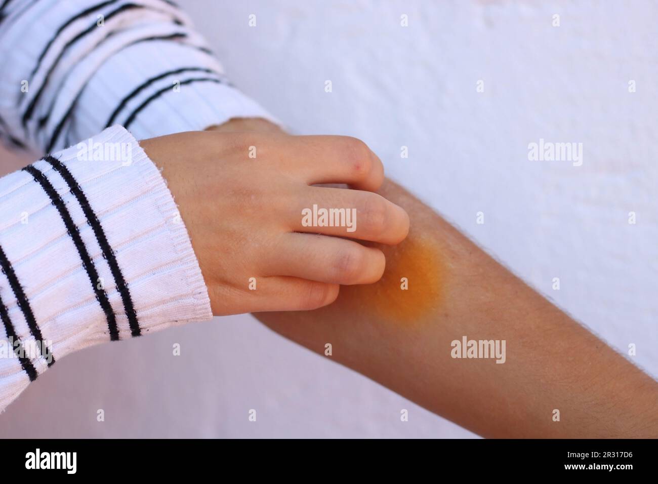 Health and medicine concept - Young women scratch the itch with hand ...