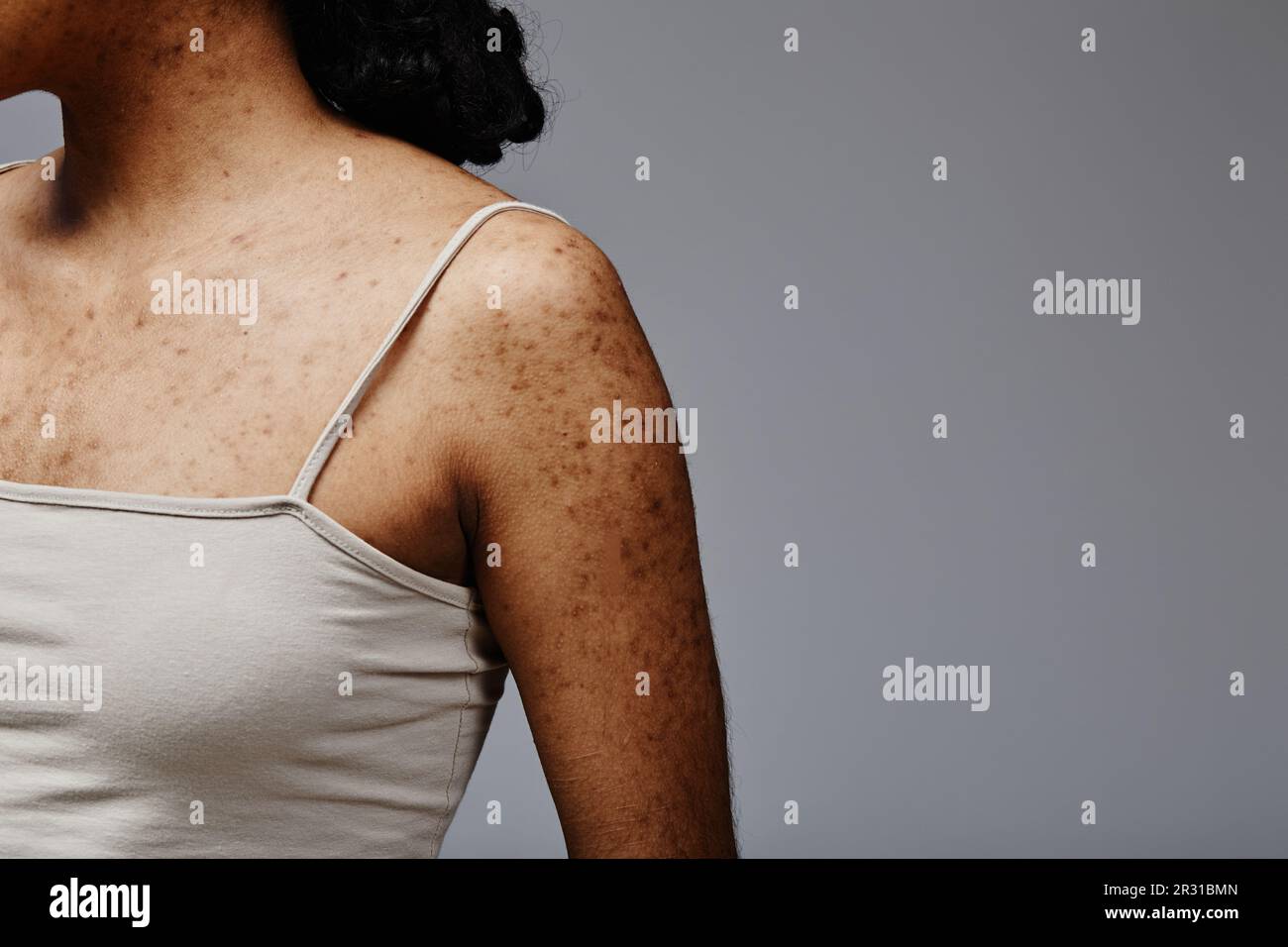Scars arm hi-res stock photography and images - Alamy