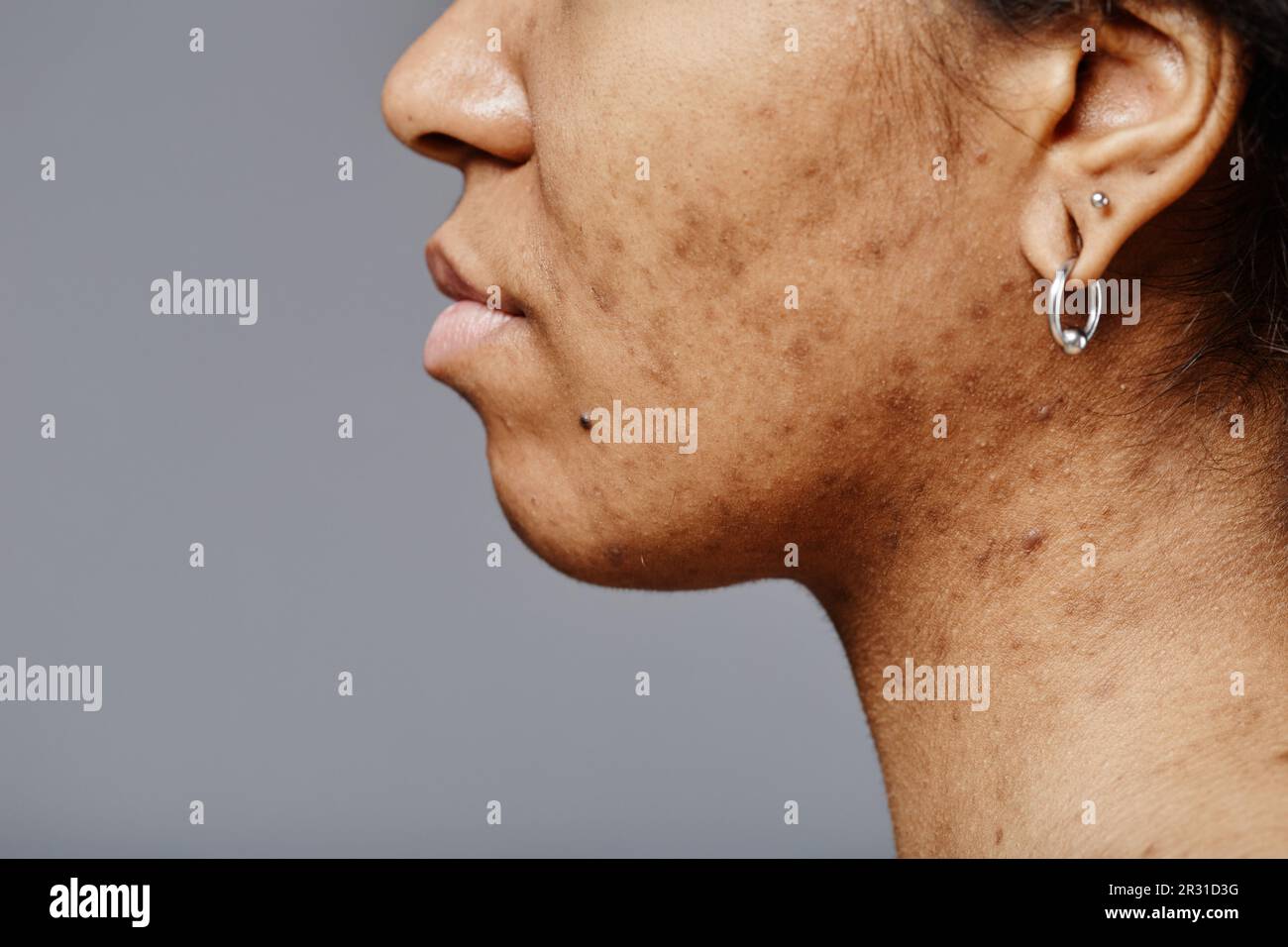 Closeup side view of black young woman with real skin texture and acne ...
