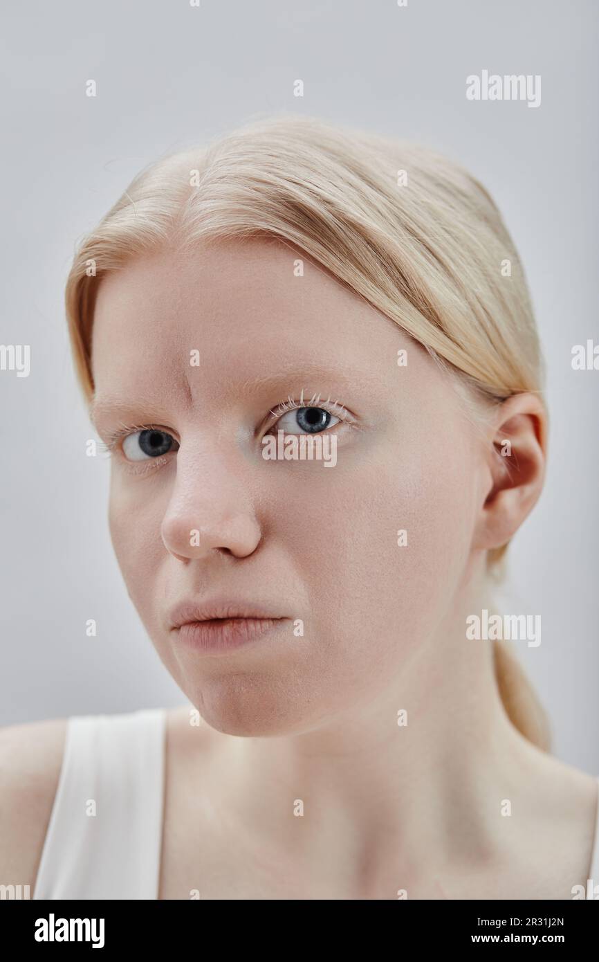Albinism awareness hi-res stock photography and images - Alamy