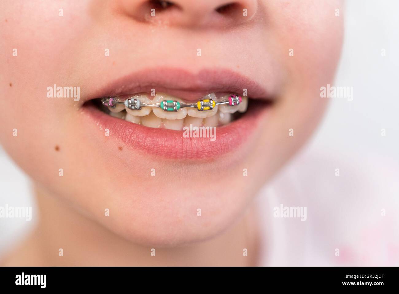 Little girl with rainbow braces Stock Photo - Alamy