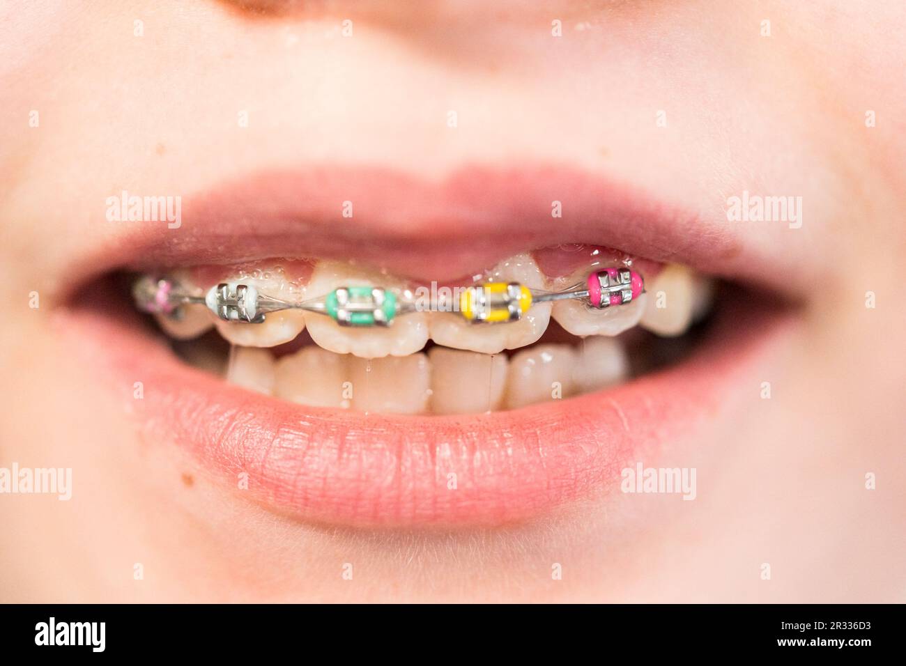 Little girl with rainbow braces Stock Photo - Alamy