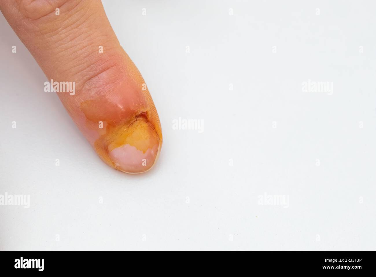 Throbbing finger hi-res stock photography and images - Alamy