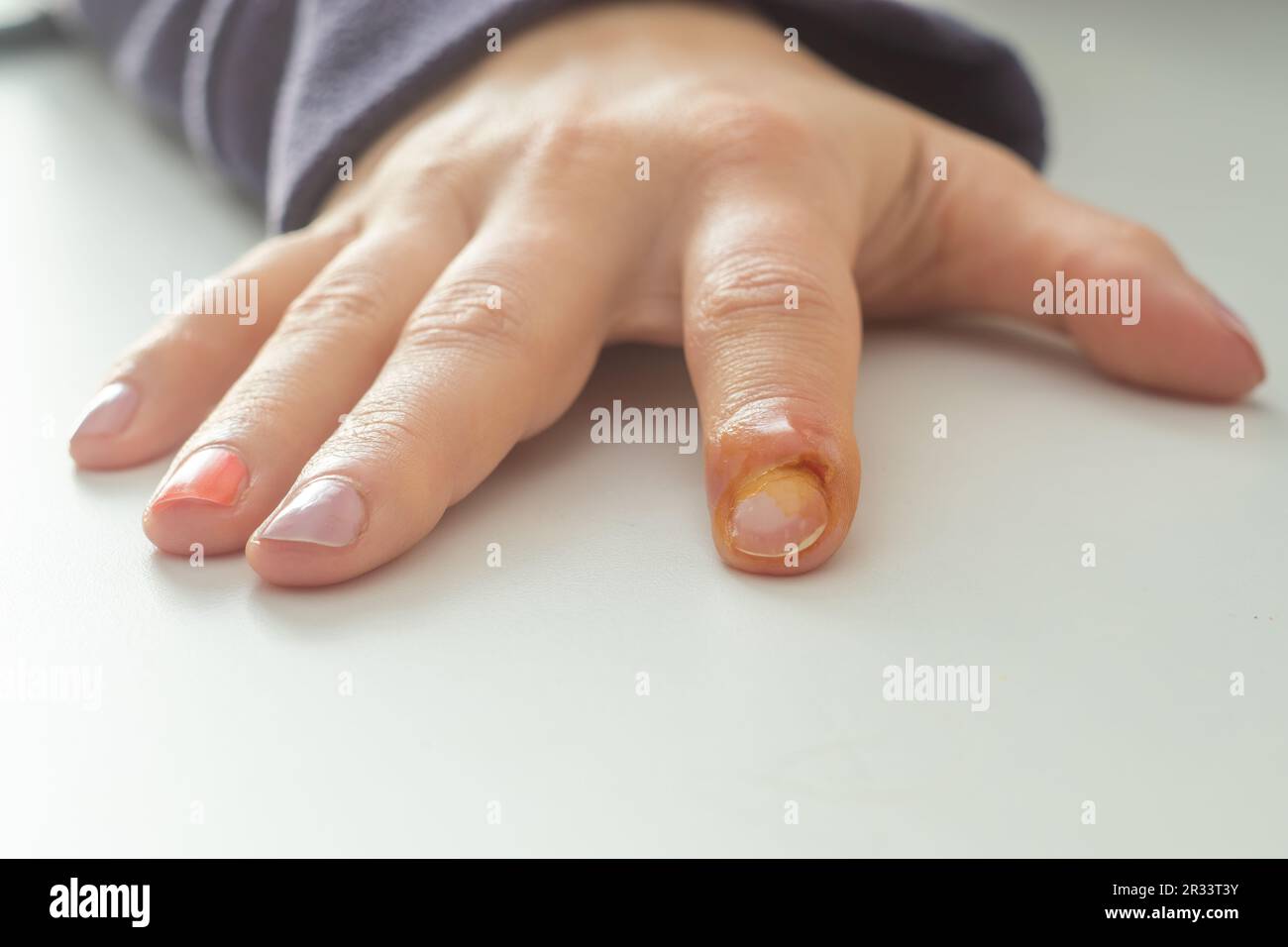 Throbbing finger hi-res stock photography and images - Alamy