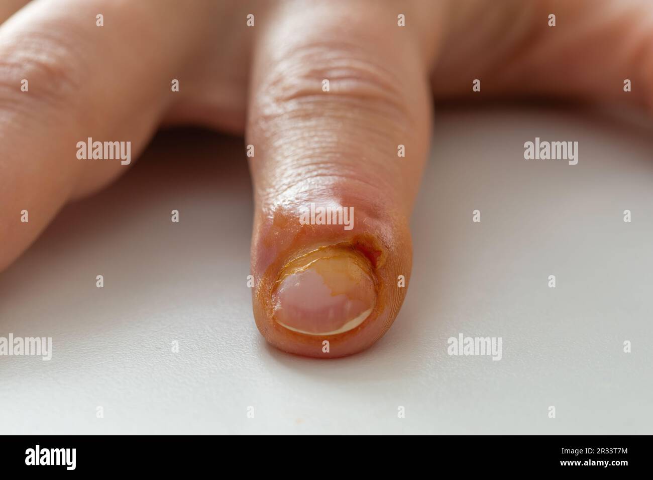Throbbing finger hi-res stock photography and images - Alamy