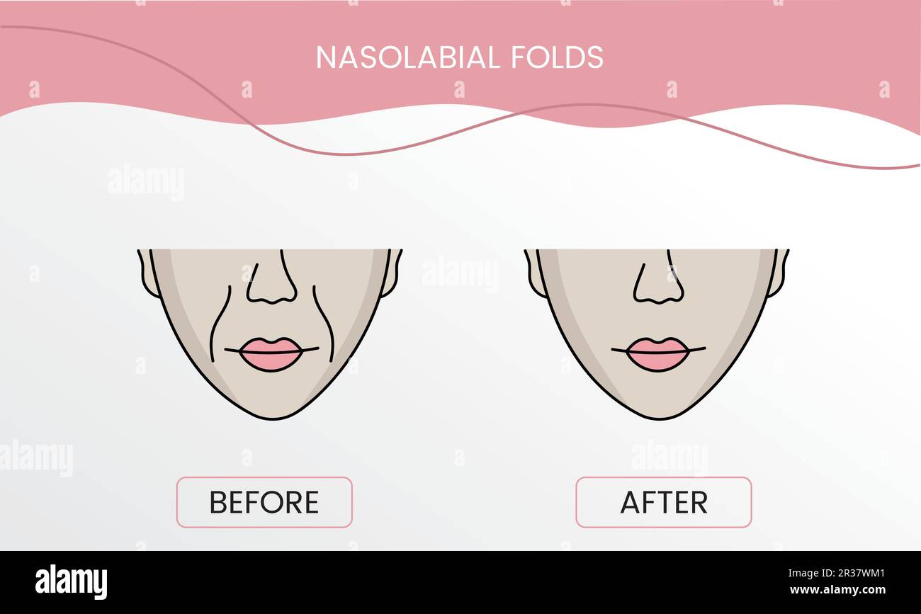 Nasolabial folds, laser cosmetology before procedure and after applying ...
