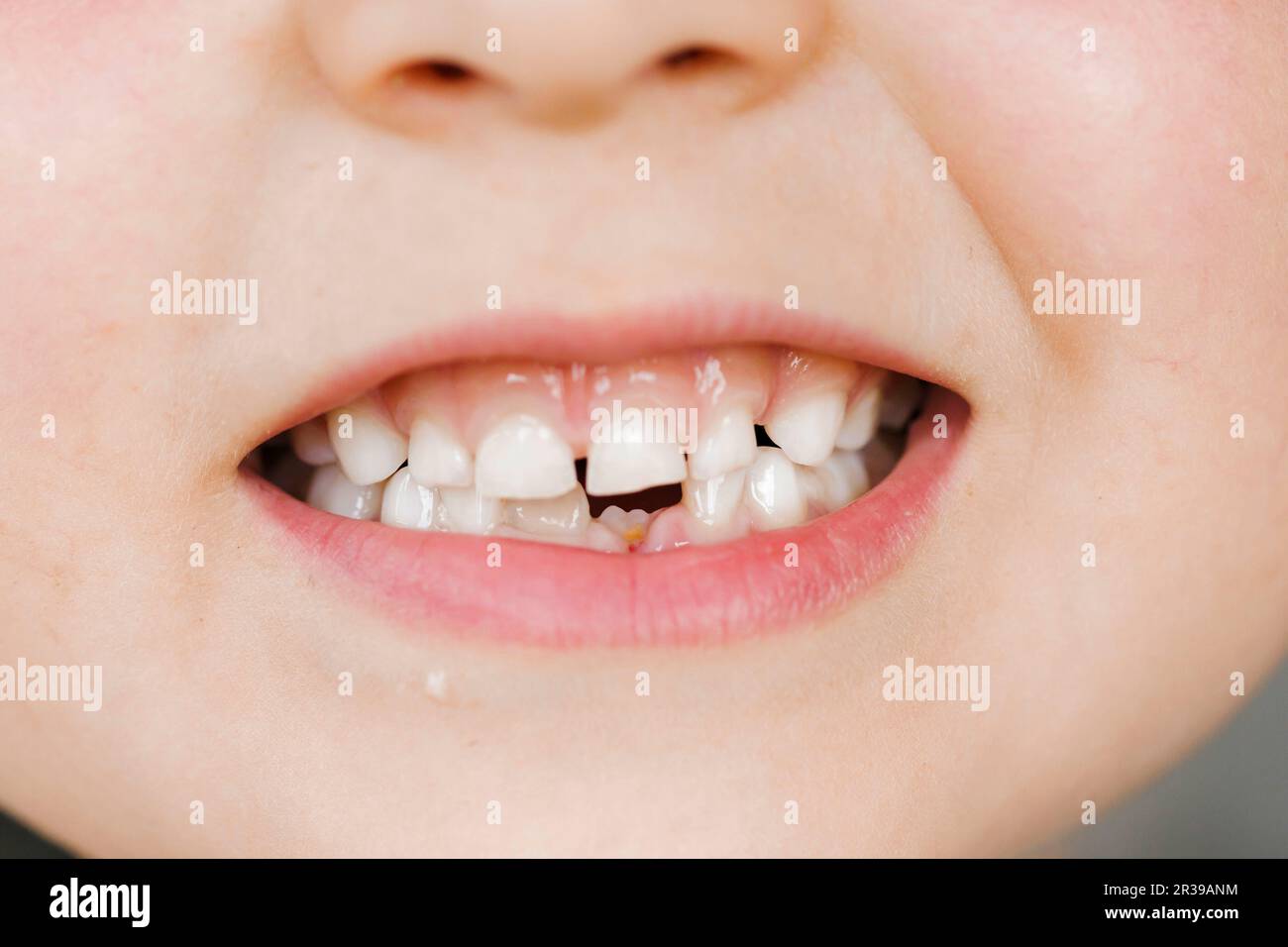 Gap tooth model hi-res stock photography and images - Alamy