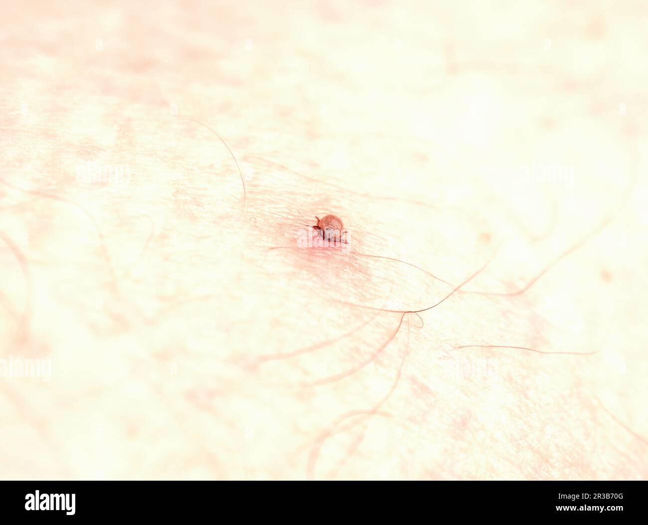 A tick has attached itself to a human leg, macro shot, health care ...