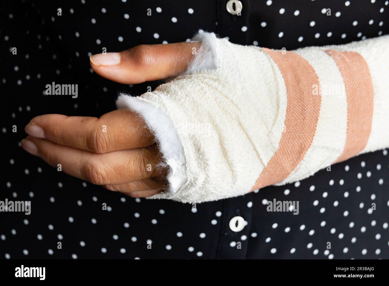 Fractured hand hi-res stock photography and images - Alamy