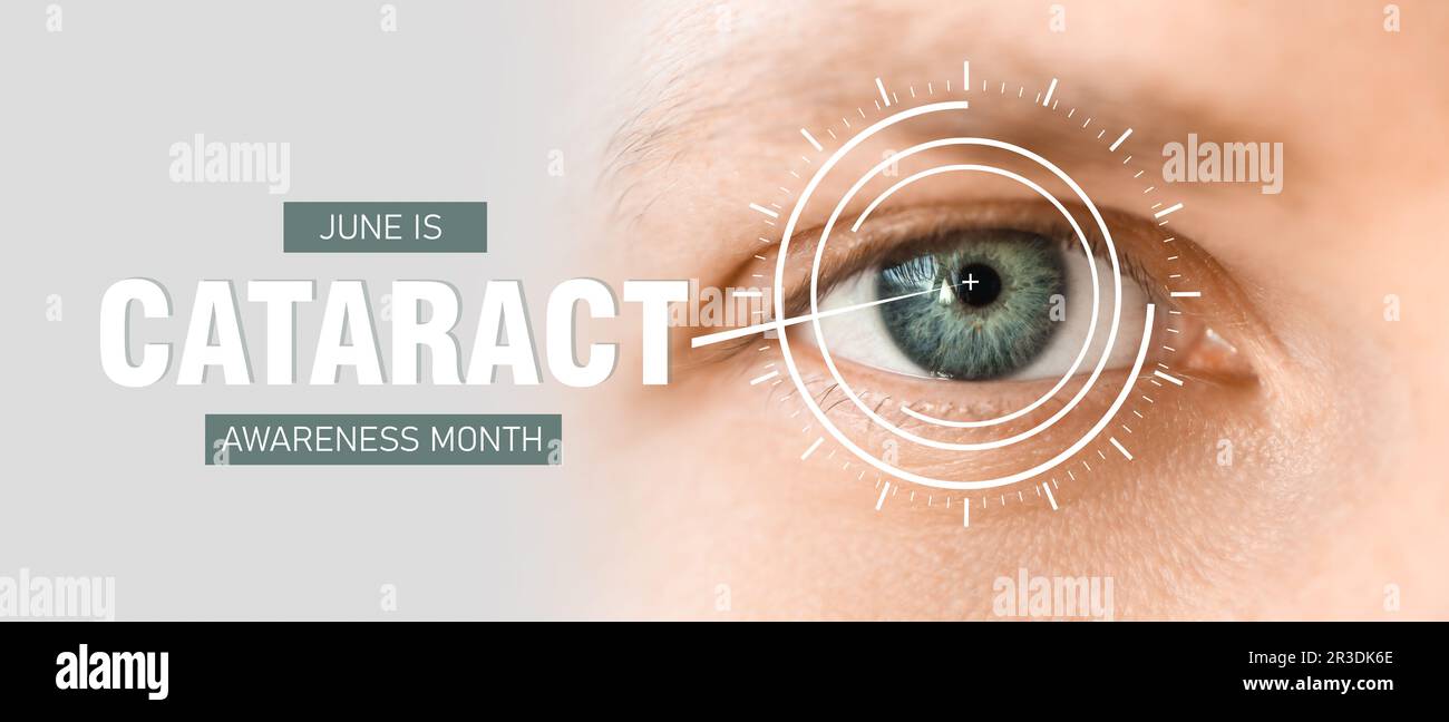 Eye of young man, closeup. Banner for Cataract Awareness Month Stock ...