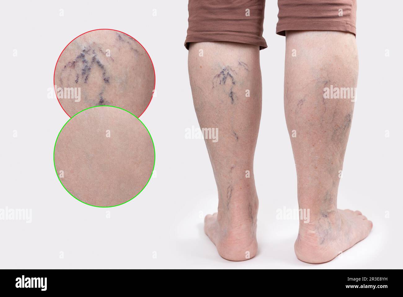 Varicosity. Close up side view of old feet of woman with vascular ...