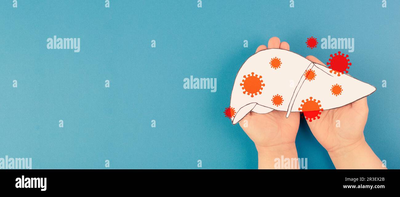 Liver organ infected with virus, world hepatitis day, diagnosis of ...