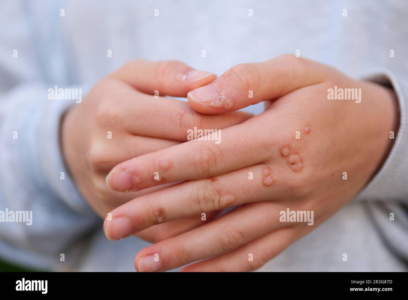 Hand with wart man skin closeup hands of young teenage girl are strewn ...