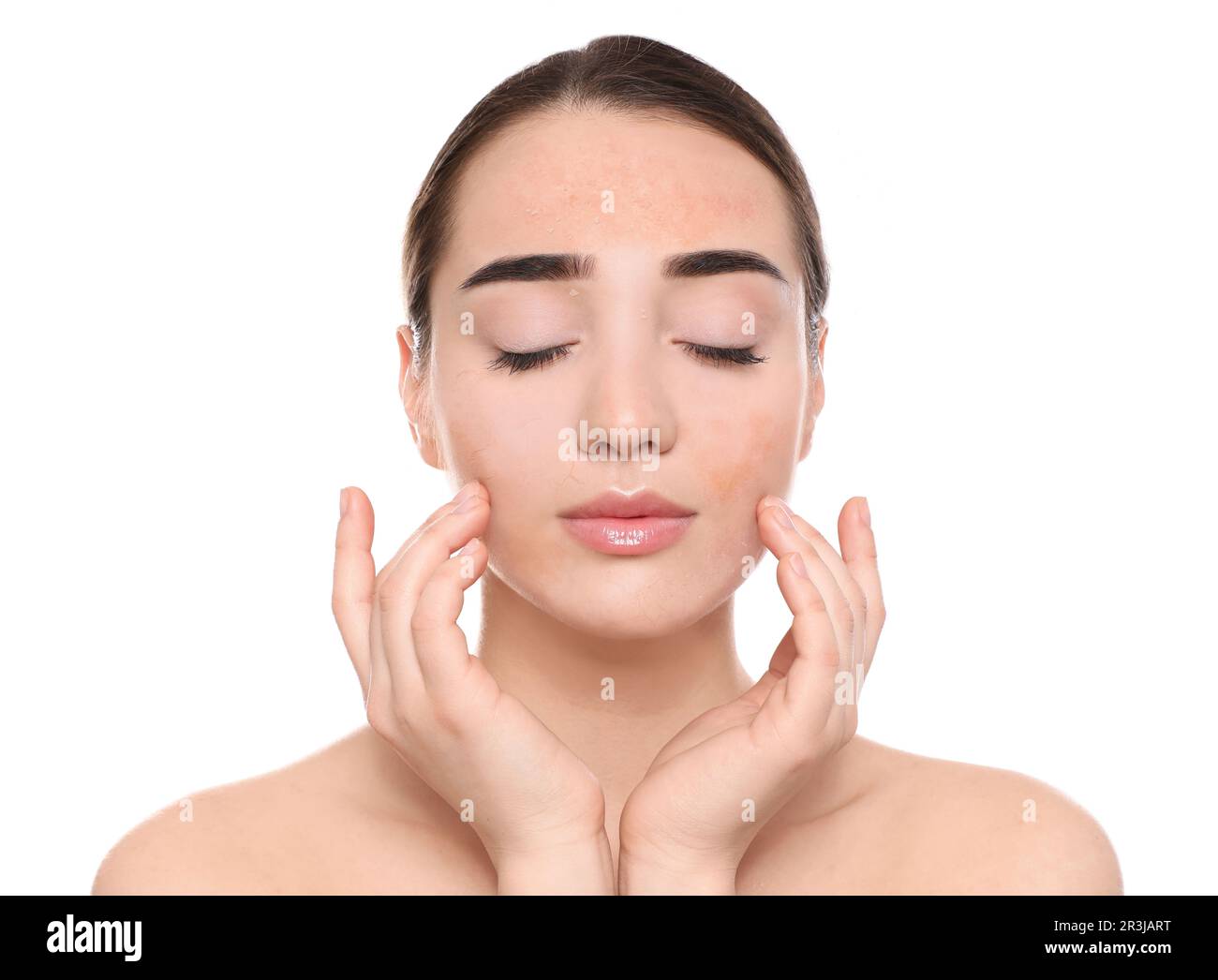 Young woman with dry skin on white background Stock Photo - Alamy