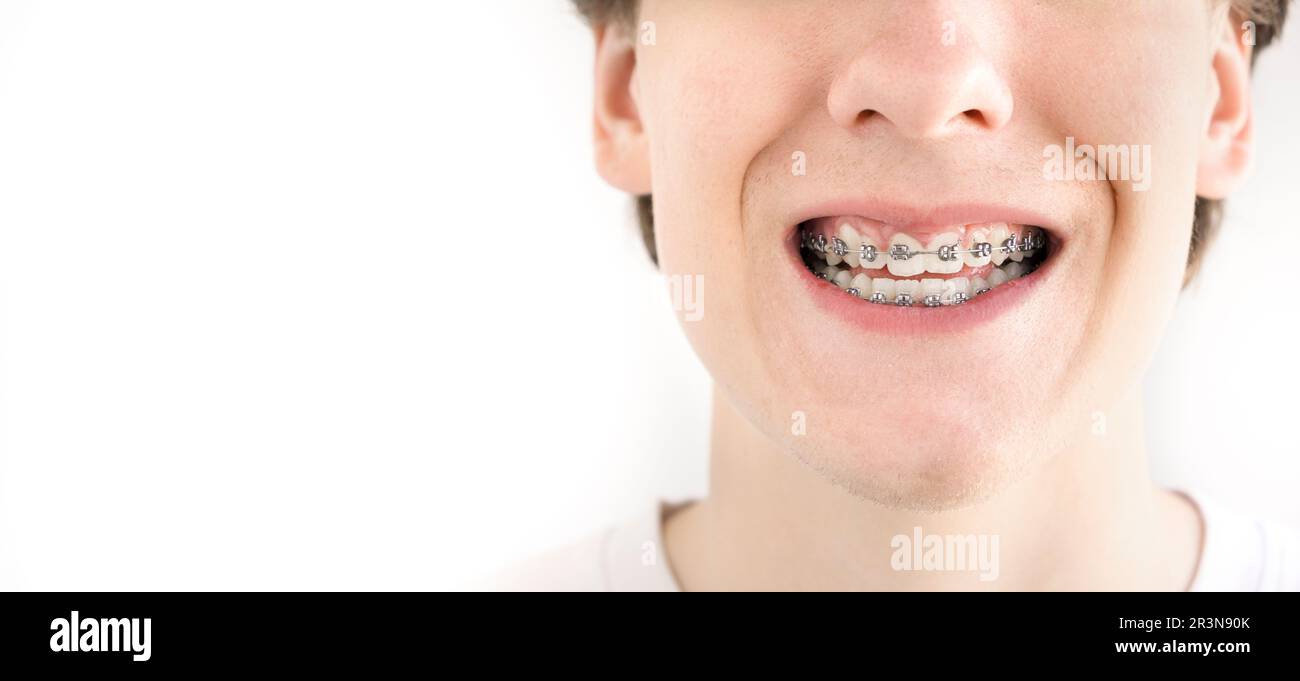 A teenager with dental braces holds interdental brush for cleaning ...