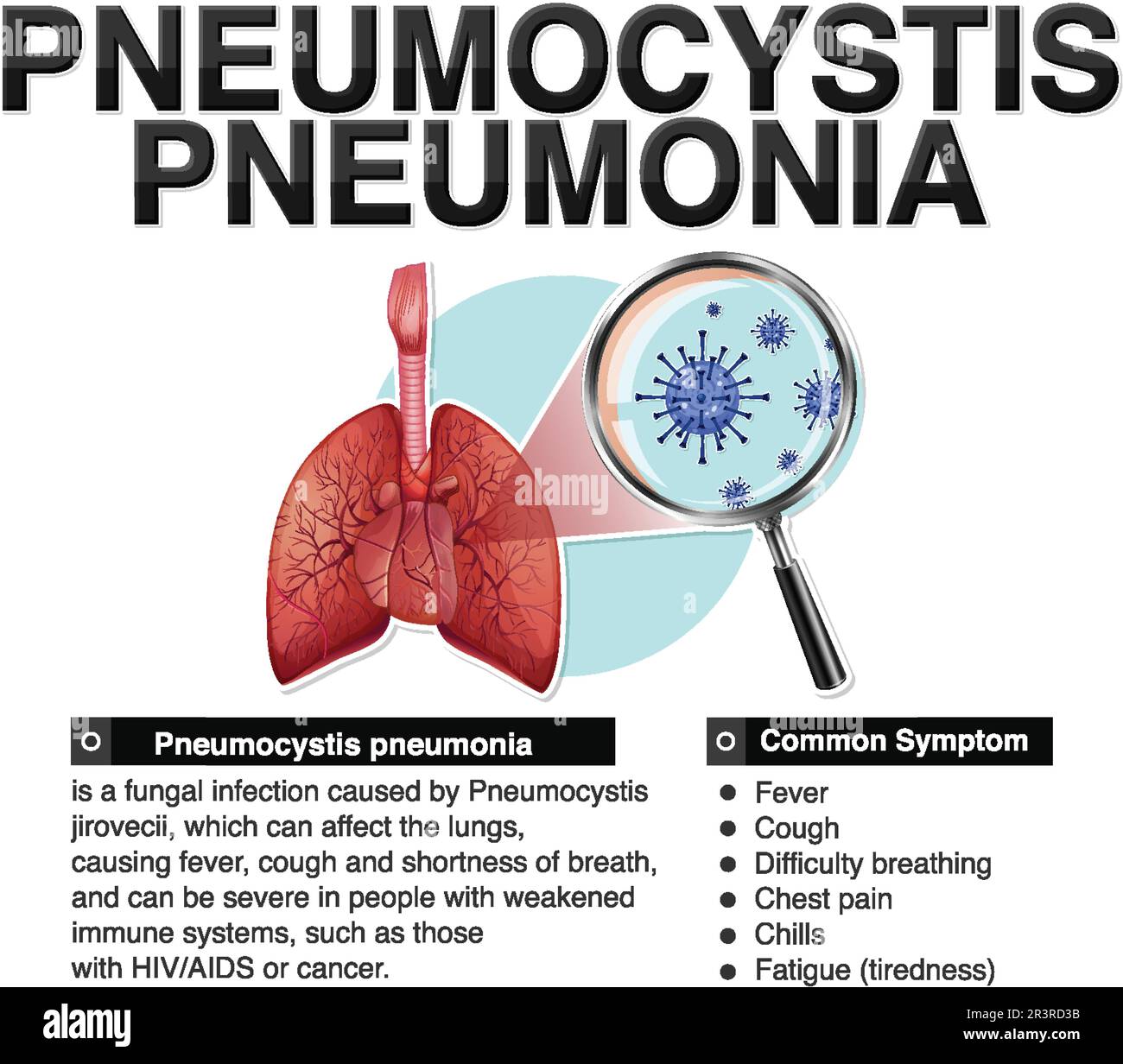 Informative poster of Pneumocystis Pneumonia illustration Stock Vector ...