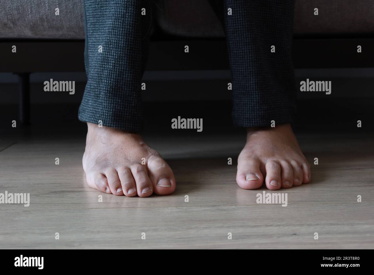 close up of women feet with swelling Stock Photo - Alamy