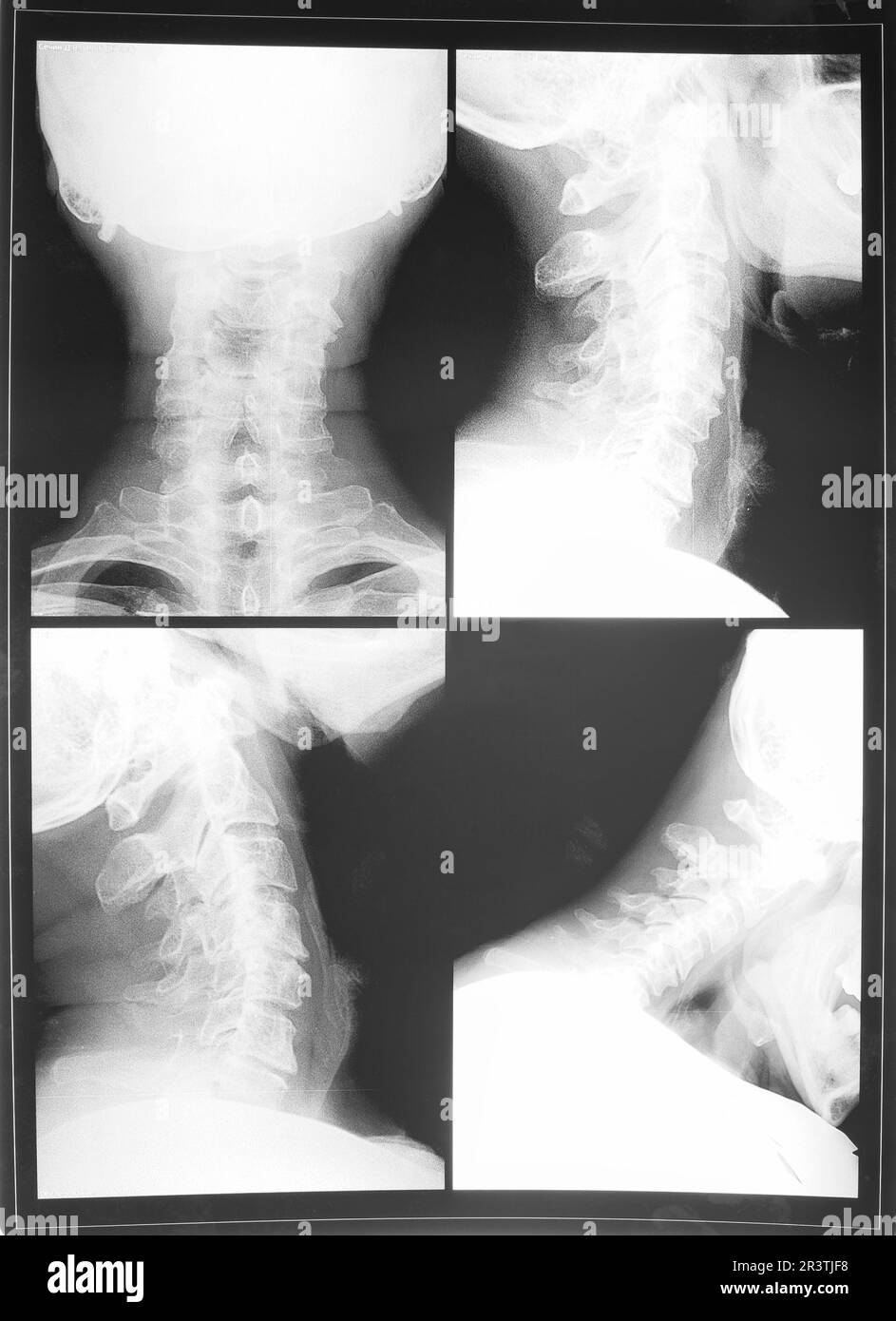 X-ray of the cervical Stock Photo - Alamy
