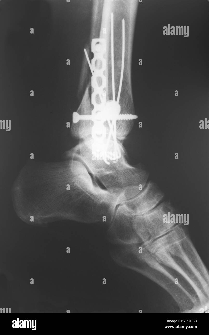 Xray Image Of Broken Leg Ap And Lateral View Stock Xray Image Of