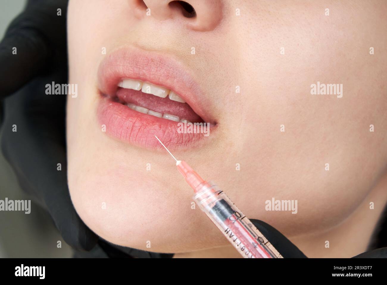 Beautiful woman gets an injection in her lips Stock Photo - Alamy