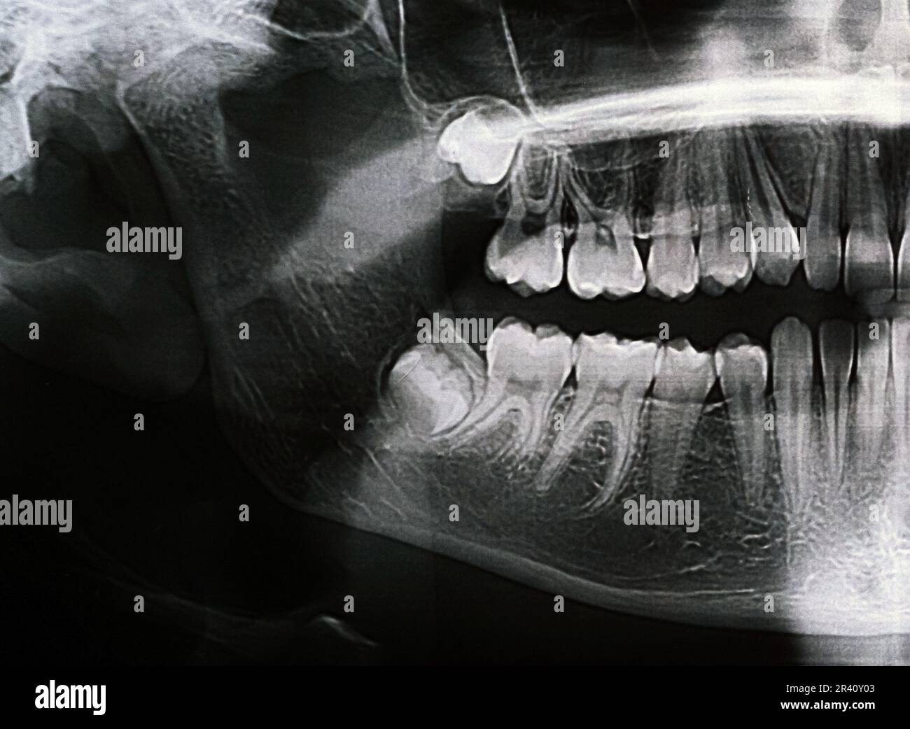 Panoramic X-ray of the jaw. X-ray of the teeth of a 12-year-old girl ...