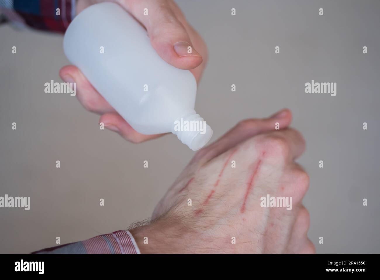 Man trying to treat cat scratches with cotton pad and hydrogen peroxide ...