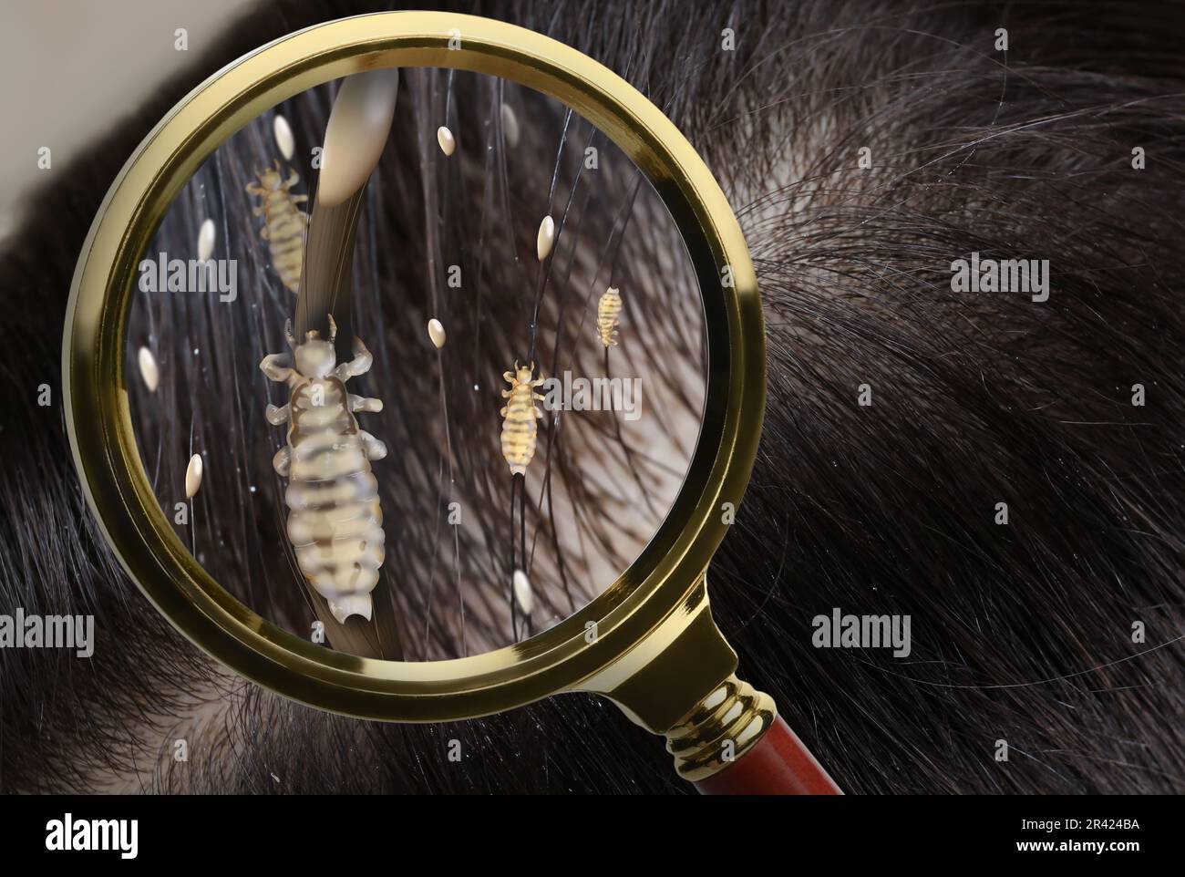 Pediculosis. Woman with lice and nits, closeup. View through magnifying ...