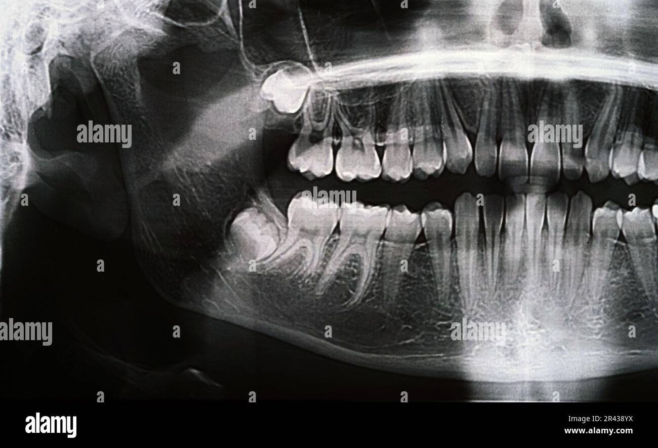 Panoramic X-ray of the jaw. X-ray of the teeth of a 12-year-old girl ...