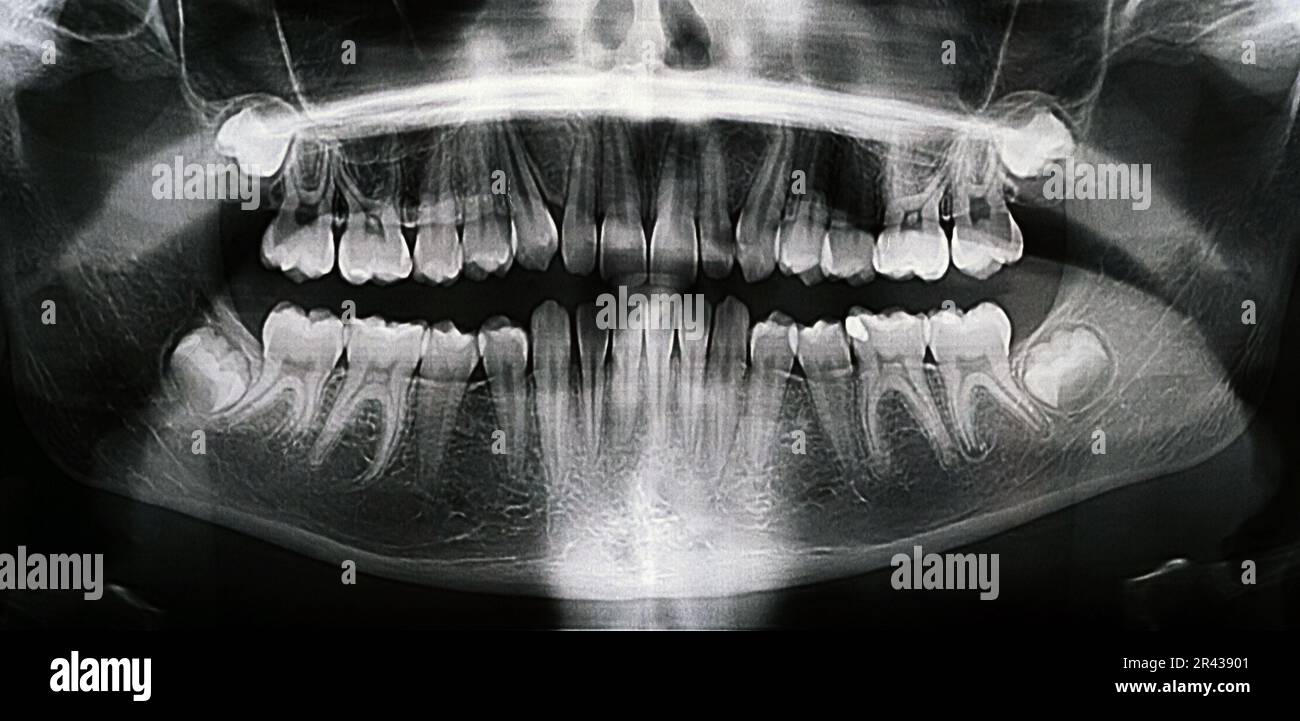 Panoramic X-ray of the jaw. X-ray of the teeth of a 12-year-old girl ...