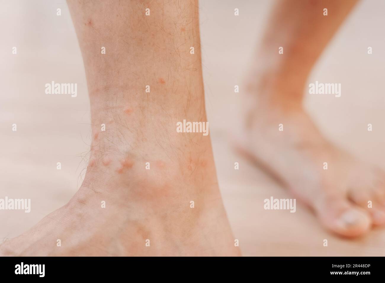 Close up allergic rash dermatitis eczema on man foot. Leg with red rash ...