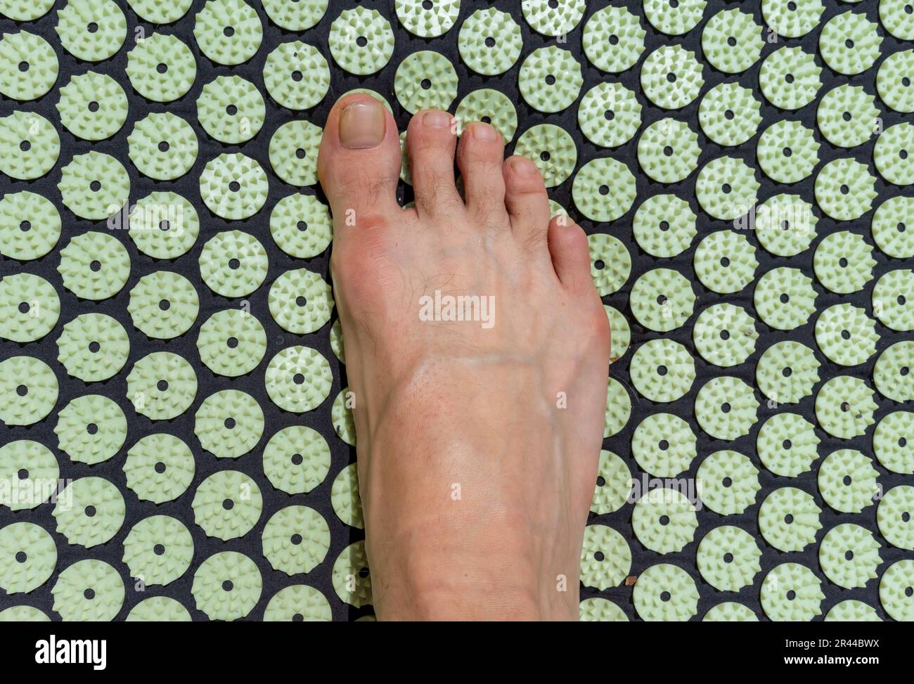 Acupuncture mat hi-res stock photography and images - Alamy