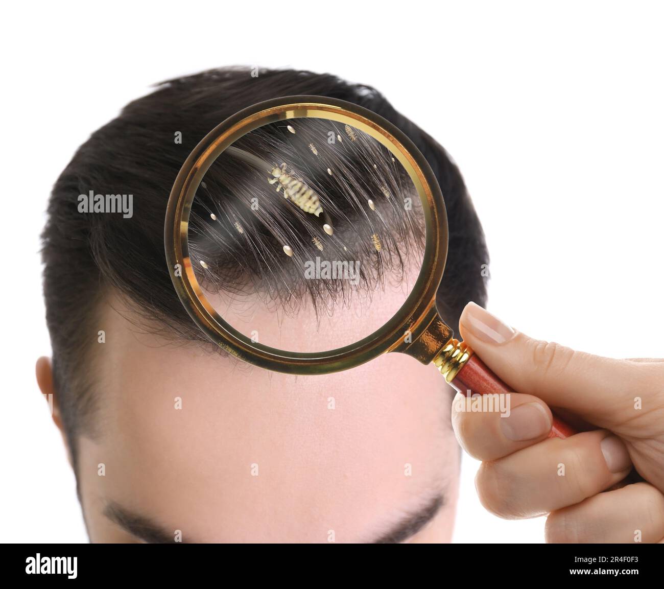 Pediculosis. Man with lice and nits on white background, closeup. View ...