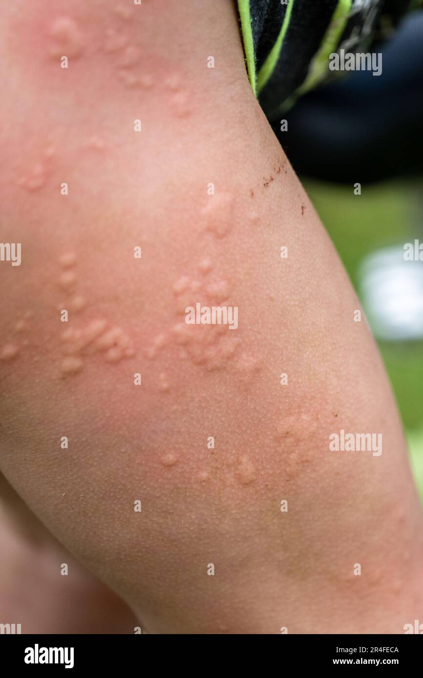 Nettle Rash Blisters