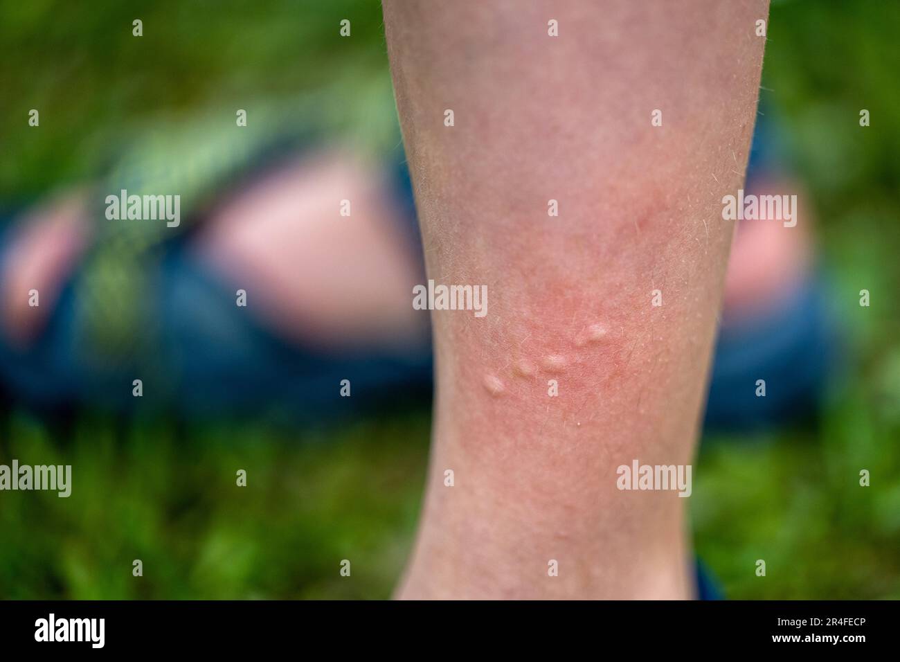 Nettle sting leg hi-res stock photography and images - Alamy