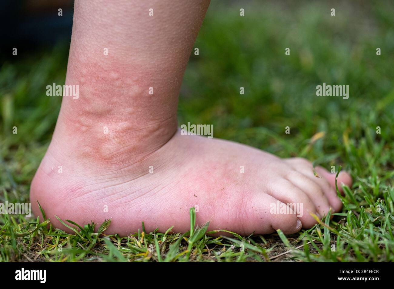 Blisters foot hi-res stock photography and images - Alamy