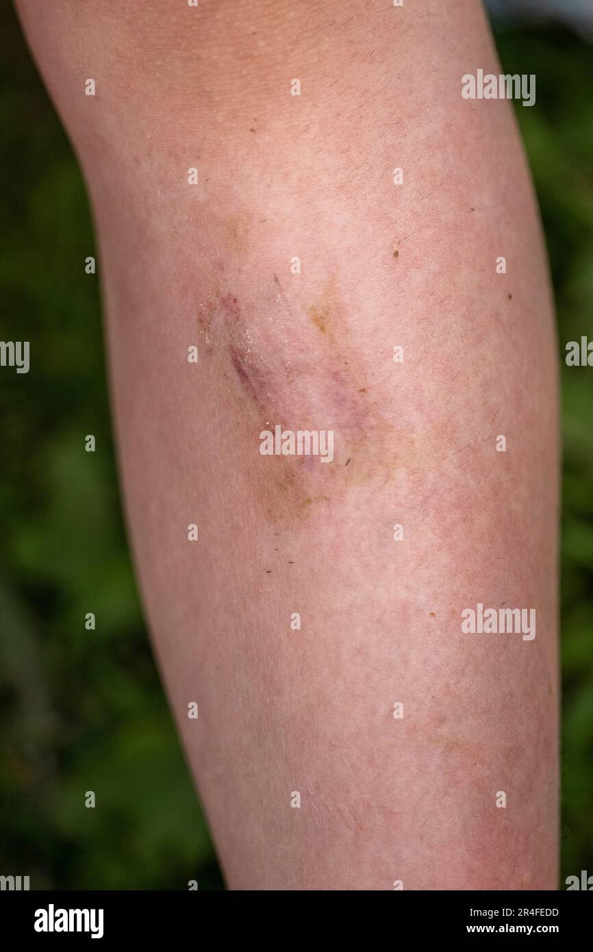 Close-up of a child's leg with a bruise after falling off a bicycle ...