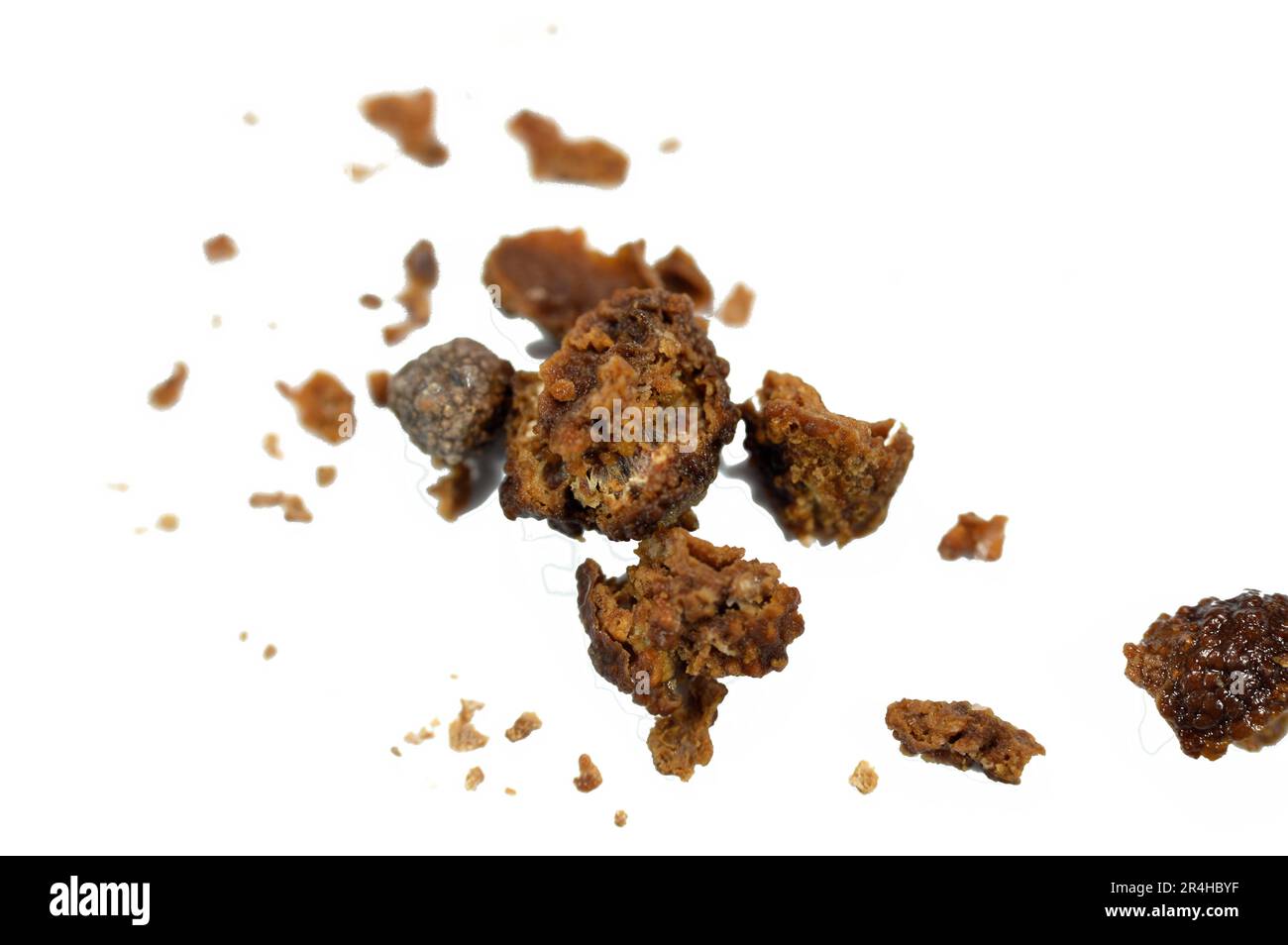 Nephrolithiasis, irregular brown kidney stones (renal calculus or ...