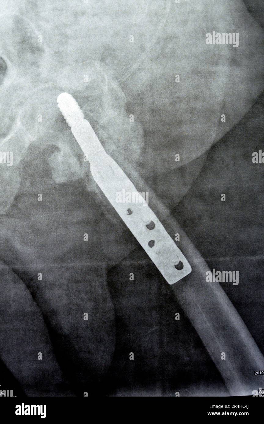 Left hip trans cervical neck of femur fracture fixated by DHS Dynamic ...