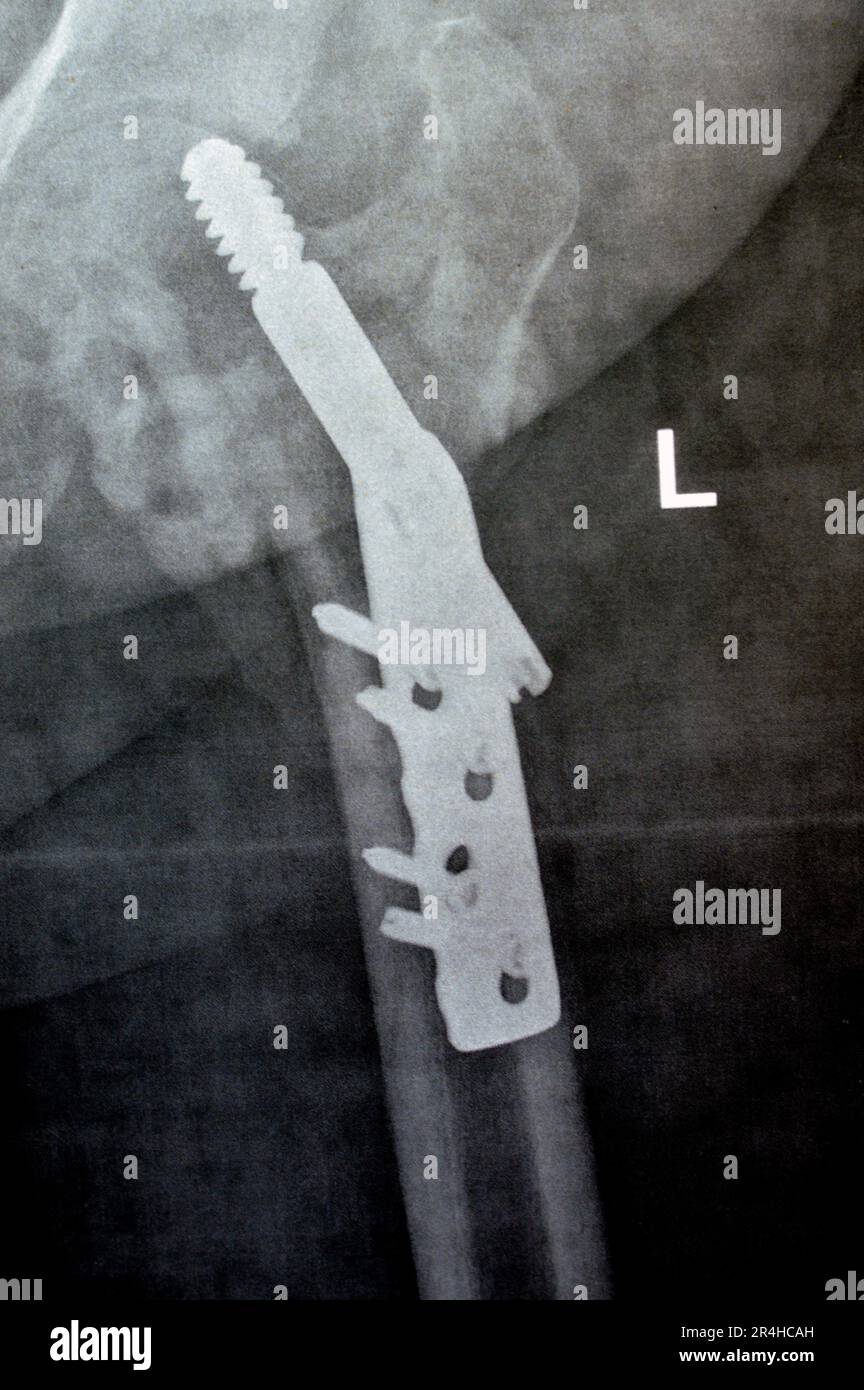 Left hip trans cervical neck of femur fracture fixated by DHS Dynamic ...